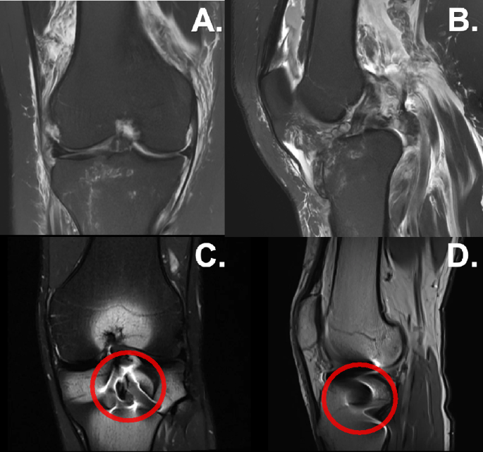 Vascular Injuries in Multiligament Knee Injuries (MLKIs) | Indian ...
