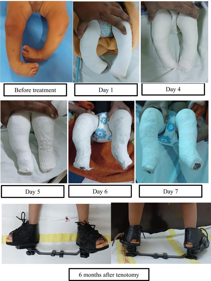 Comparison of 1 Week Accelerated Ponseti and Standard Ponseti Technique ...