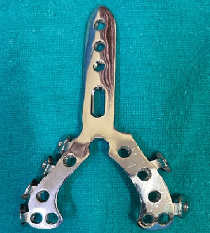 Designing of a Distal Humerus Anatomical Biplanar Locking Fixation ...