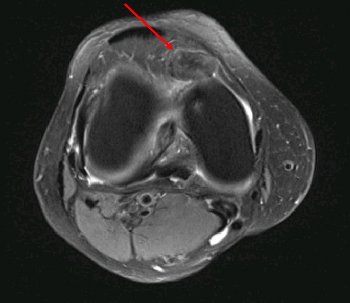 Hoffa–Kastert Syndrome: A Rare Cause of Acute Knee Blockade | Indian ...