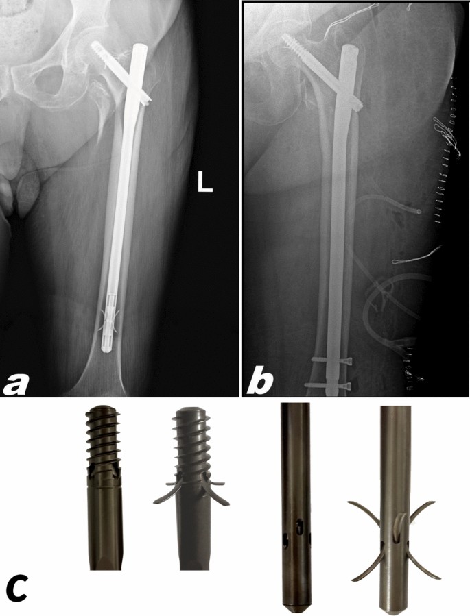 Mechanistic Insights Into Lag Screw Cut-Out: The Impact of Distal ...