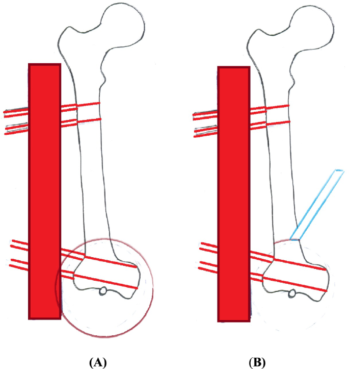 Fixator-Assisted Nailing for Acute Correction of Periarticular Knee ...