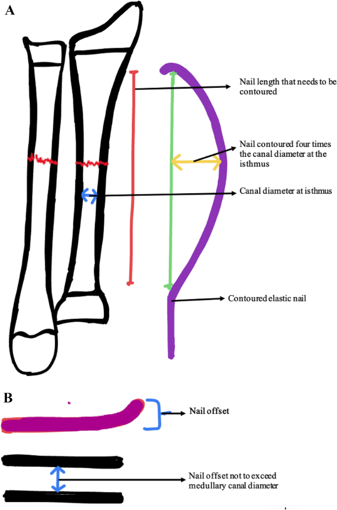 Utility of Elastic Stable Intramedullary Nails in Pediatric Forearm ...