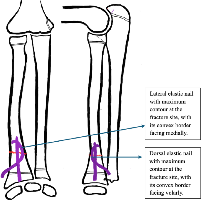Utility of Elastic Stable Intramedullary Nails in Pediatric Forearm ...