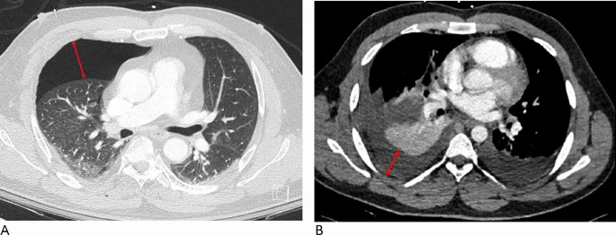 Just the Facts: an update on the management of traumatic hemothorax and ...