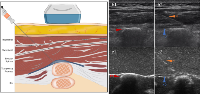 Simulation tools in ultrasound-guided regional anesthesia: developing a ...
