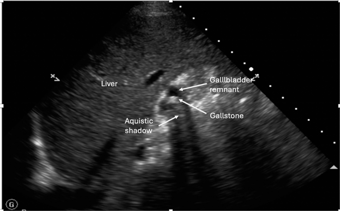 Retained gallstone found in a remnant gallbladder post-laparoscopic ...