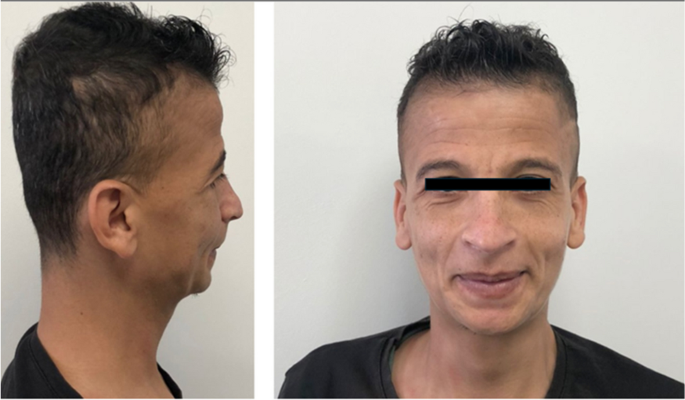 Woodhouse-Sakati syndrome: genotype–phenotype review and case of intra ...