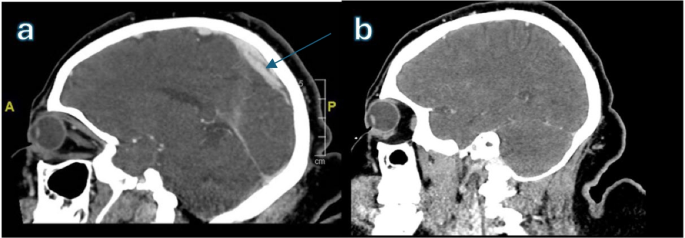 Cerebral vein thrombosis as the initial presentation of acute ...