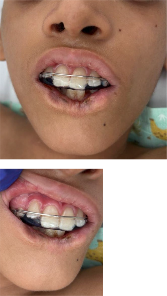 Conservative management of oral self-mutilation in Lesch–Nyhan syndrome ...