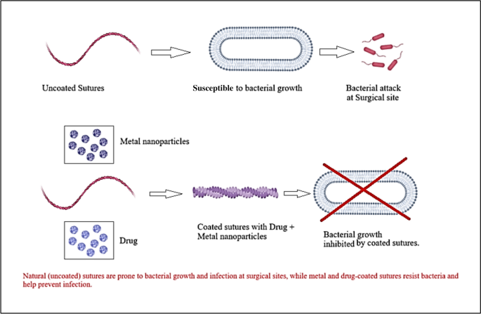 Exploring the Potential of Metal-Loaded Sutures in Preventing Surgical ...