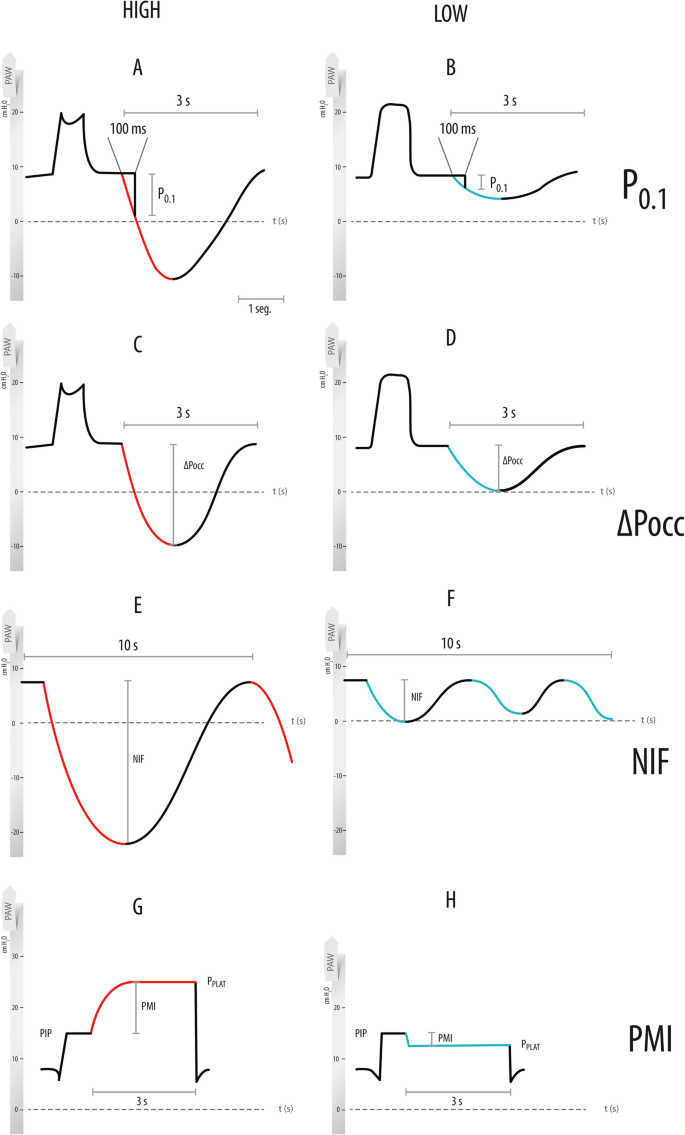 How to quantify respiratory effort and drive in critically ill children ...