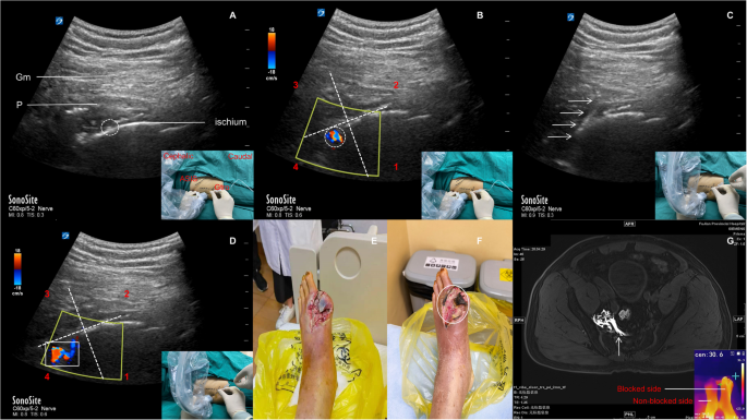 The innovative approach of continuous lateral parasacral ischial plane ...