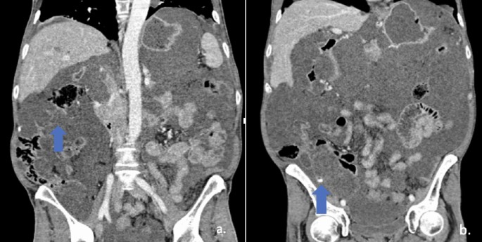 Peritoneal Pseudomyxoma In A Patient Affected By Appendicular Mucocele