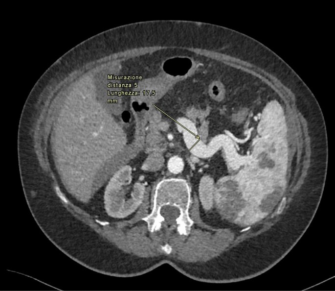 Primary splenic angiosarcoma: a rare case of embolization as a bridge ...