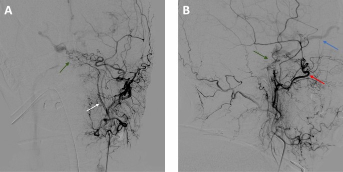 Endovascular transvenous treatment of carotid–cavernous fistula ...