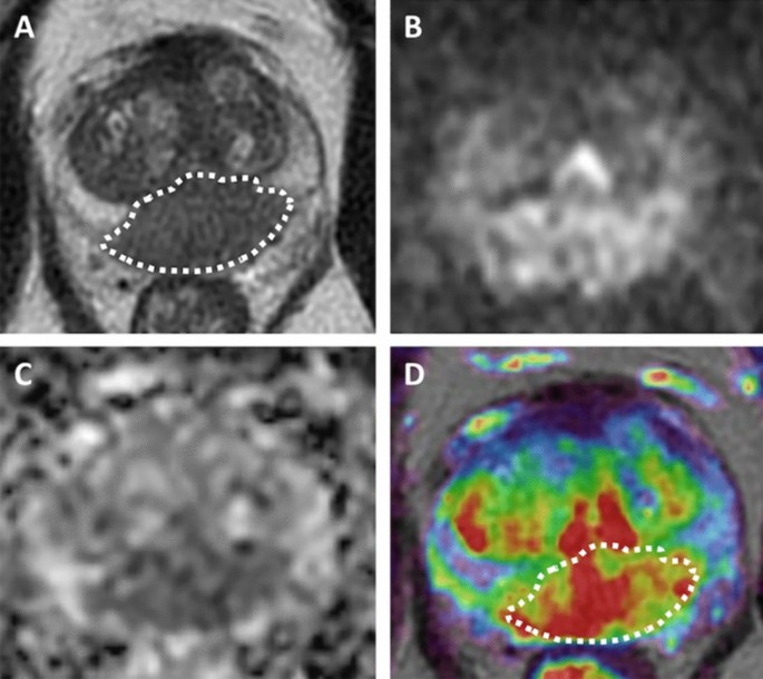 Multi-parametric magnetic resonance imaging of prostate cancer ...