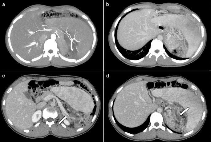An unexpected surprise: splenic volvulus | Journal of Medical Imaging ...