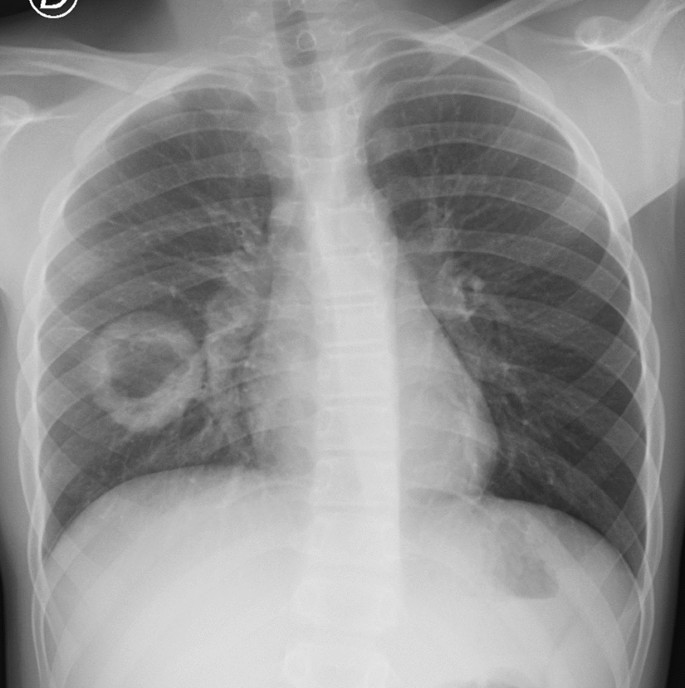 A challenging chest X-ray in the pediatric immunocompetent patient ...