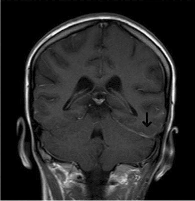 Acute myeloid leukemia first presentation with central nervous system ...