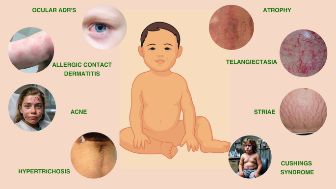 Optimized and safe use of topical corticosteroids in pediatric ...