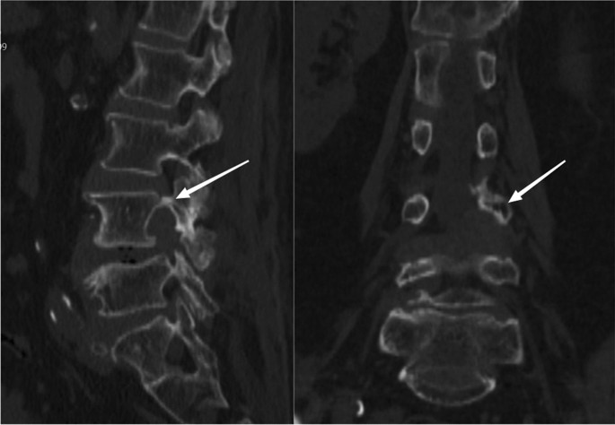 Giant foramen disc herniation with pedicle hypoplasia:a case report and ...