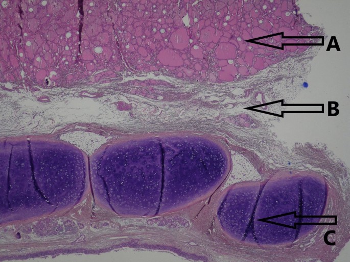 Investigation of thyroid tissue in berry ligament by dissecting 103 ...