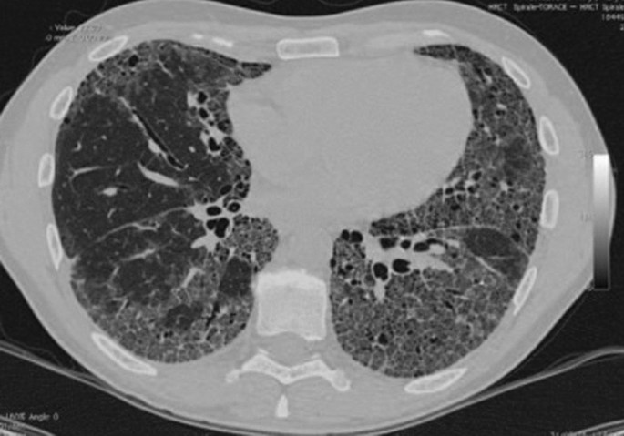 Lung involvement in rheumatoid arthritis: what do we know? | Discover ...