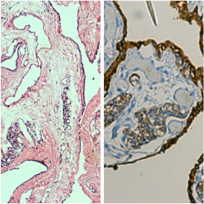 A rare case of parathyroid cyst mimicking thyroid nodule: clinical ...