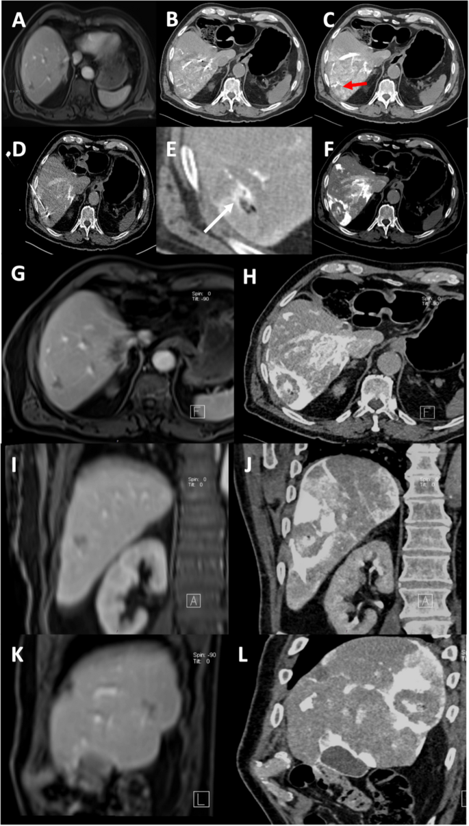 The role of CT hepatic angiography with contrast tagging in liver ...
