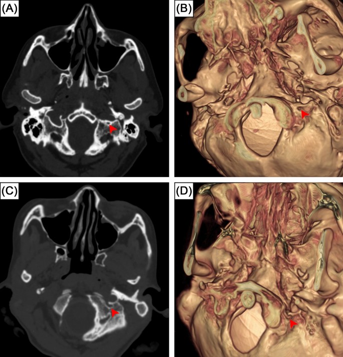 Radiological Study of the Intermediate Condylar Canal | Bratislava ...