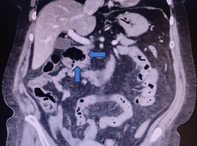 An Acute Abdomen Caused by a Contained Perforation of a Jejunal ...