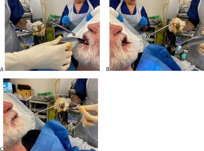 Transnasal percutaneous endoscopic gastrostomy (T-PEG): a case series ...