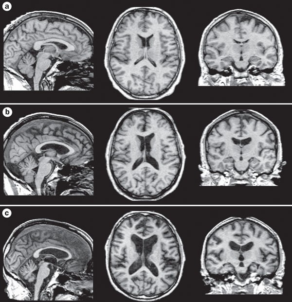 Clinical and pathological features of alcohol-related brain damage ...