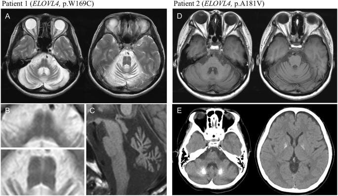 Whole exome sequencing in Japanese spinocerebellar ataxia identifies novel variants | Journal of ...