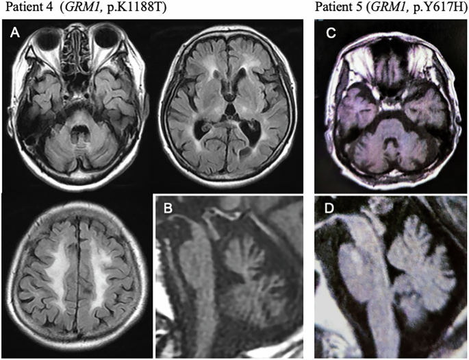Whole exome sequencing in Japanese spinocerebellar ataxia identifies novel variants | Journal of ...