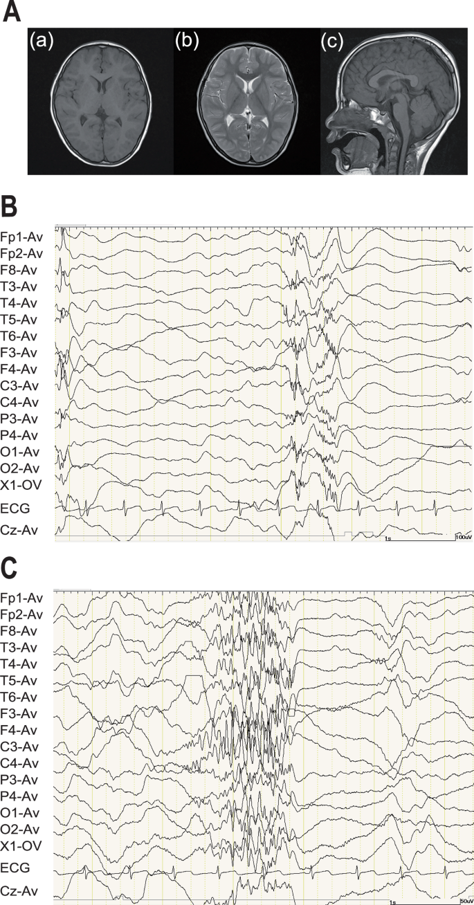 Compound heterozygous variants of CACNA1H change channel properties and ...