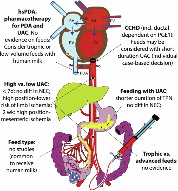 Safety of enteral nutrition practices in neonates with umbilical ...