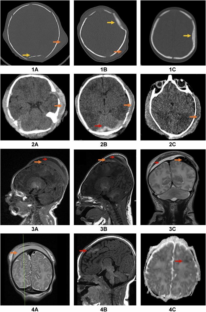 Risk factors for subgaleal hemorrhage and adverse early neonatal ...