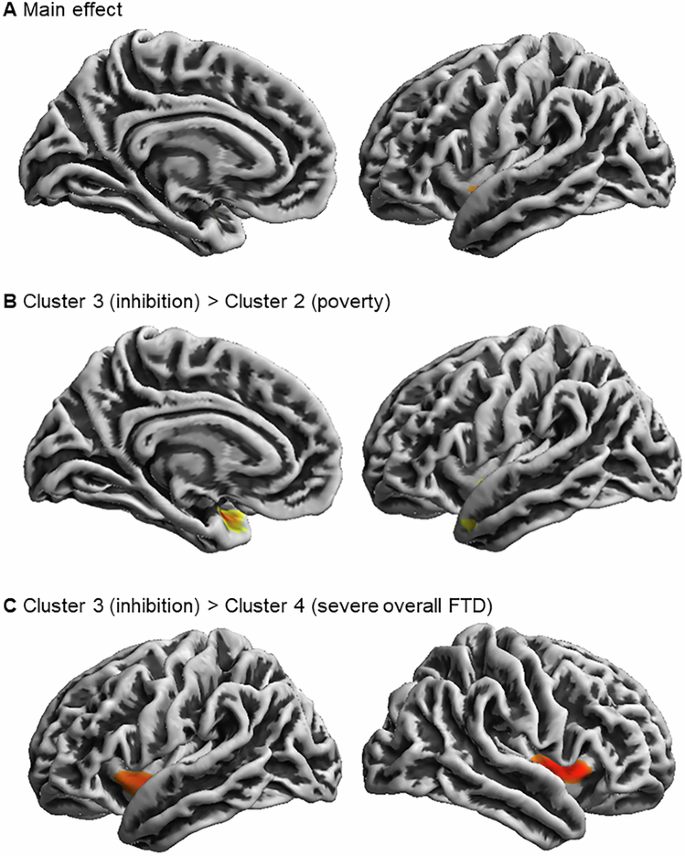Transdiagnostic types of formal thought disorder and their association ...