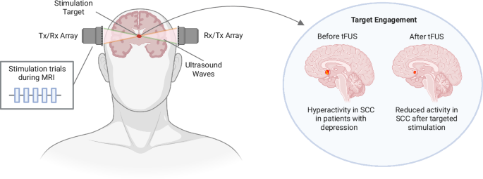 Brainwaves meet soundwaves: ultrasound stimulation for treating major ...