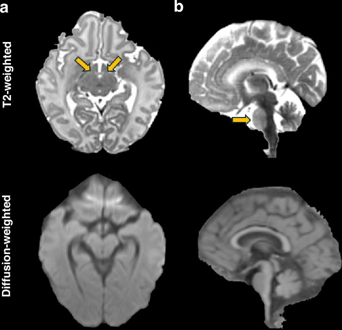 Brain MRI T2 hyperintensity and neurodevelopmental outcomes in neonatal ...