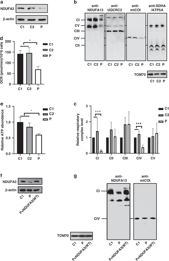 Identification of novel NDUFA3 variants in a patient with mitochondrial ...