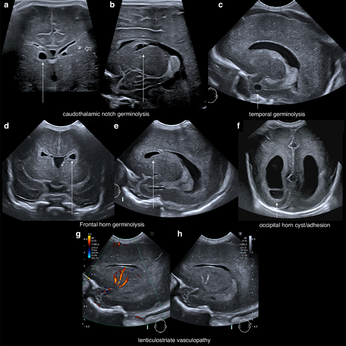 Neuro-imaging in cCMV infection: let’s try and speak the same language ...