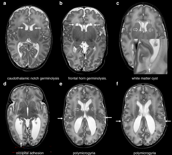 Neuro-imaging in cCMV infection: let’s try and speak the same language ...