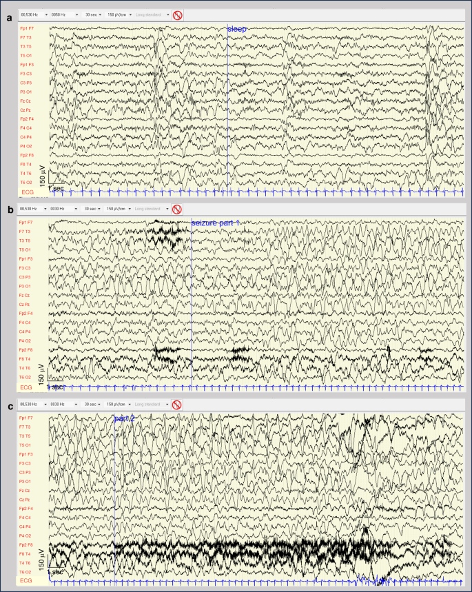 Acute encephalopathy with biphasic seizures and late reduced diffusion ...