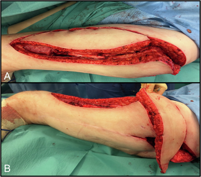 Flap reconstruction of pressure ulcers in patients with spinal cord ...