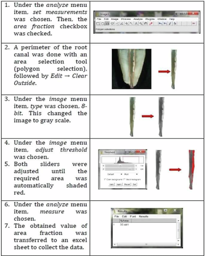 Impact of LASER activated irrigation on the retrievability of Guttaflow ...