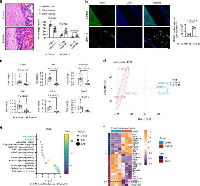 Melanoma bone metastasis-induced osteocyte ferroptosis via the HIF1α ...