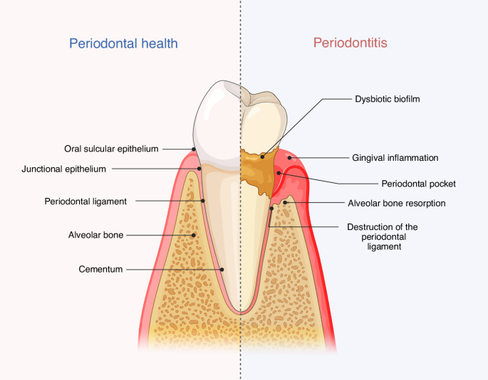 Inflammatory bone loss and signaling pathways in periodontitis ...
